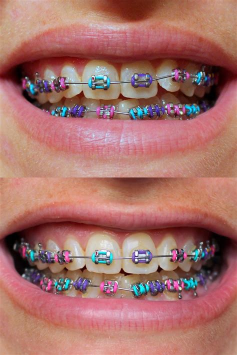 Pastel Colors Braces At Beth Meeks Blog