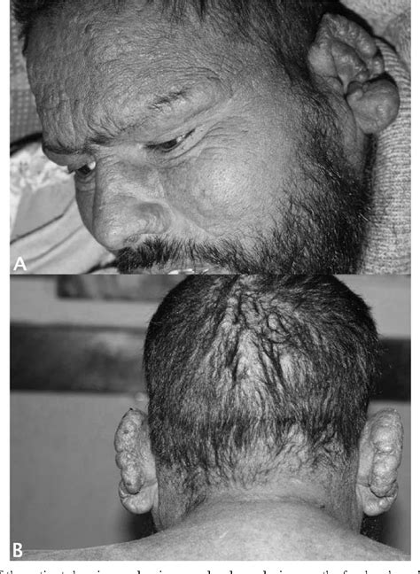 Abscess Lymph Node At Jason Quinn Blog