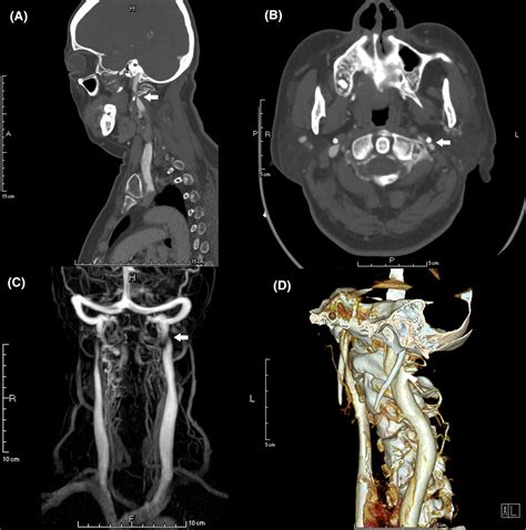 Cervical Spondylotic Internal Jugular Venous Compression Syndrome