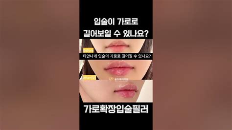 💋 입술필러 로 입술이 가로로 길어보일 수 있나요 가로확장입술필러 Youtube