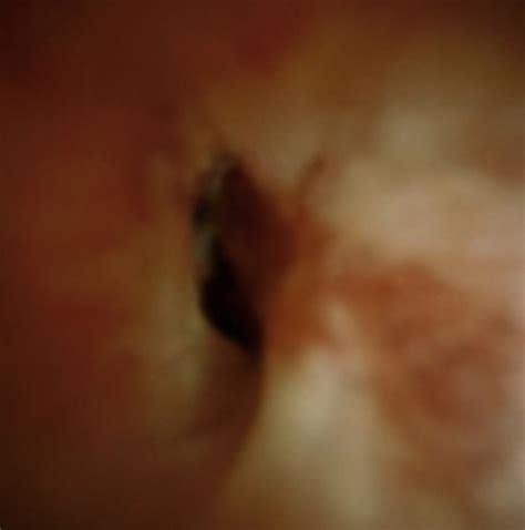 Cholangioscopy In Primary Sclerosing Cholangitis A Case Series Of
