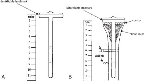 Figure 1 From Total Knee Replacement With Interlocking Stems Semantic
