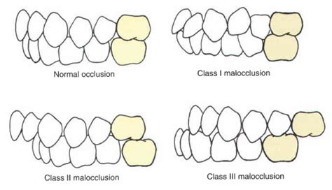 Class 1 Malocclusion Causes Signs And Treatment Atlas Dental