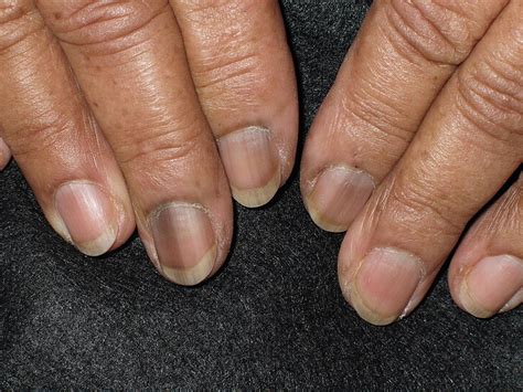 Longitudinal Melanonychia As The First Sign Of Addisons Disease Journal Of The American