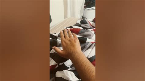 Day 45 After Metacrapal Neck Surgery ☠️ Hand Youtube