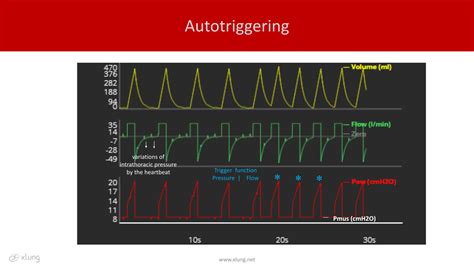 Assincronia Paciente Ventilador Mecânico