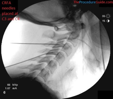 Fluoroscopic Guided Lumbar Medial Branch Block Lmbb Technique And Overview The Procedure Guide