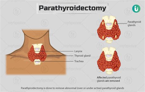 Parathyroidectomy Procedure Purpose Results Cost Price Indications Recovery
