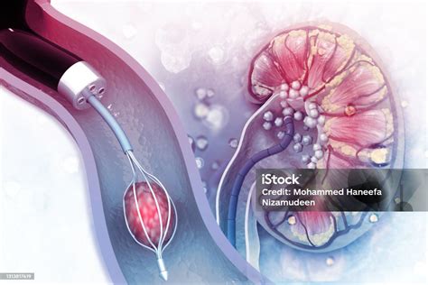 신장 결석을 제거합니다 3d 일러스트레이션 신장학에 대한 스톡 사진 및 기타 이미지 신장학 비뇨기과 의사 소변 Istock