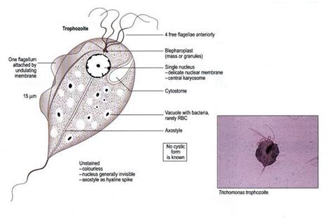 Pathology Outlines Trichomonas Vaginalis