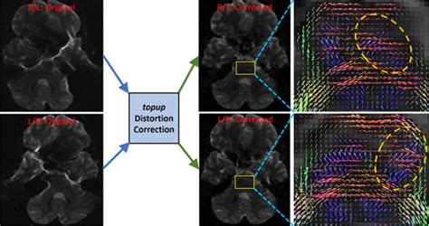 An Illustration Of The Problem In Susceptibility Distortion Correction Download Scientific