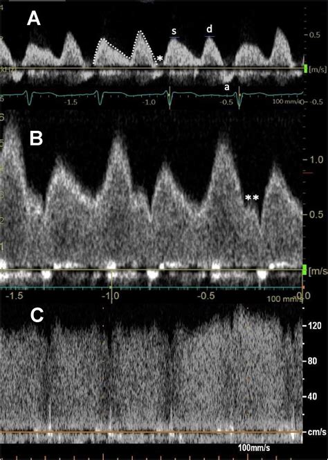 Doppler Echocardiographic Features Of Pulmonary Vein Stenosis In Ex