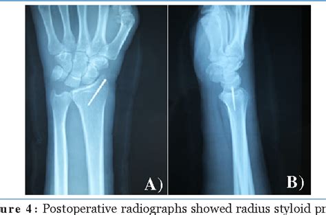 Radial Styloid Process Fracture