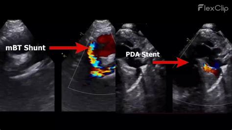 Evan Emad On Linkedin 📌 Mbt Shunt Vs Pda Stent Dip Avqx