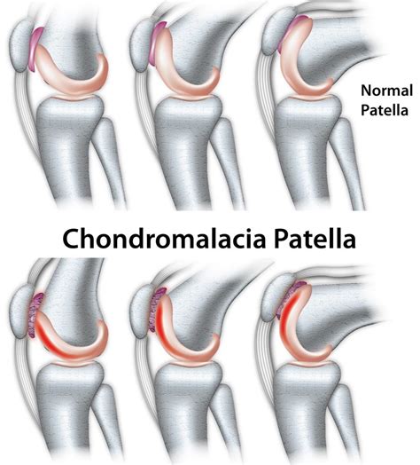 Chondromalacia Patella Causes And Treatment Sportnova Uk