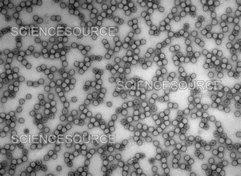Polio Virus Under Microscope Acute Poliomyelitis Practice Essentials