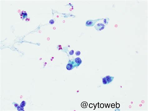 Mystery Cases Eus Fna 4 Nus Pathweb Nus Pathweb