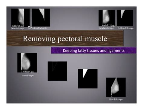 Microcalcification Identification In Digital Mammogram For Early