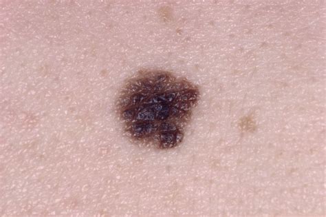 Expanded Biopsy Margin For Dysplastic Nevi Reduces Need For Second Procedure Dermatology Advisor