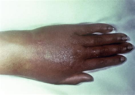 Gonococcal Infection Symptoms
