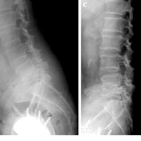 A Case Of L4 5 Infection With An Anterior Interbody Fusion With