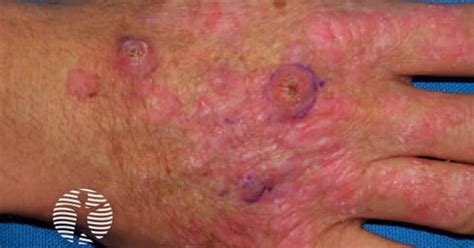 Dermnet® Actinic Keratoses Affecting The Hands Image