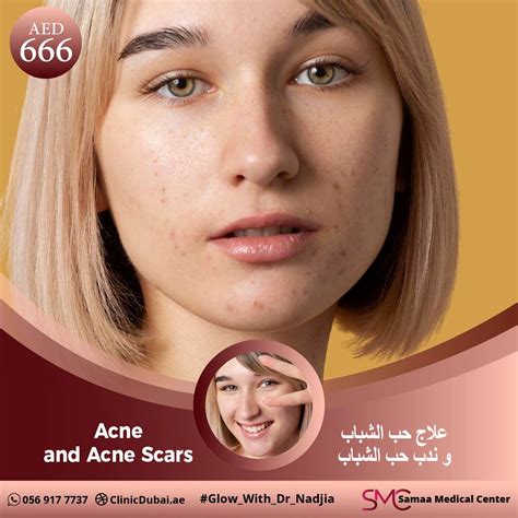 Acne And Acne Scars Buy And Sell Anything Online Tabadull Uae
