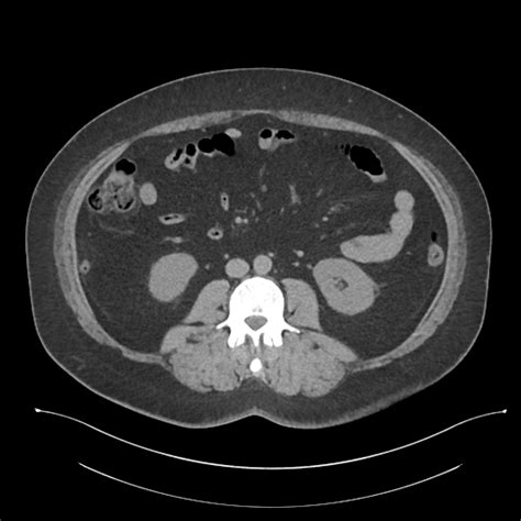 Subhepatic Appendicitis Image