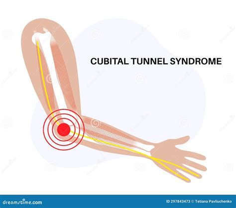 Cubital Tunnel Syndrome Cartoon Vector 296432649