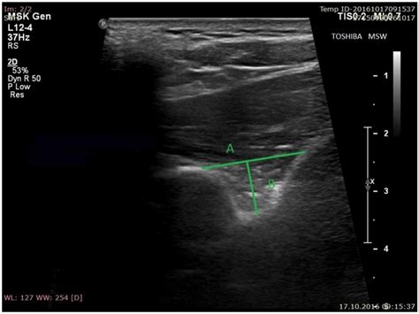 Suprascapular Notch Ultrasound My Xxx Hot Girl