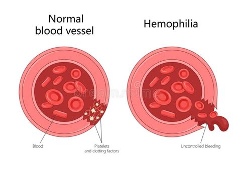 Normal Blood Vessel Hemophilia Comparison Diagram Stock Illustration