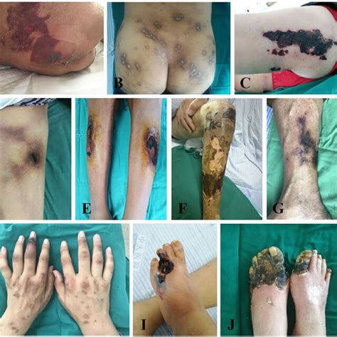 Histopathological Features Of Calciphylaxis Calciphylaxis Skin Biopsy Download Scientific