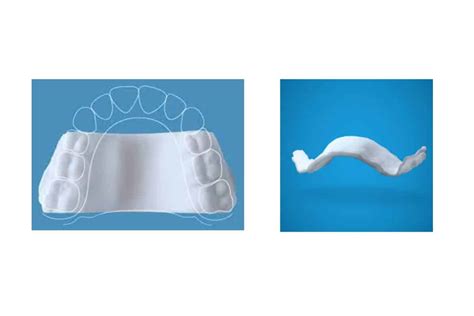Invisalign Palatal Expander A Comprehensive Guide