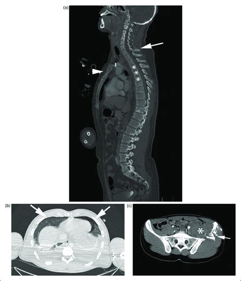 Different Windowing To Show Different Tissues Preferentially And