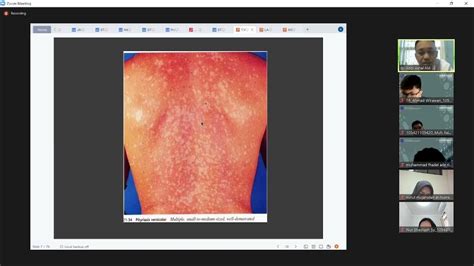 Tinea Versikolor Kandidosis Kutis Dan Penyakit Jamur Profunda Youtube