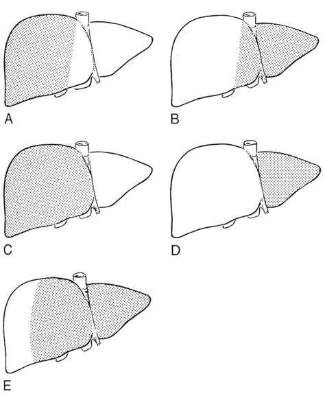 Commonly Performed Hepatic Resections Shown In The Shaded Areas A