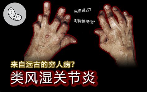 类风湿关节炎不死的癌症来自远古对称性侵蚀灰细胞 灰细胞 灰细胞 哔哩哔哩视频