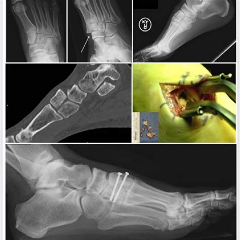 Case 2 Initial Radiographs Revealing Right Foot Dorsal First Download Scientific Diagram