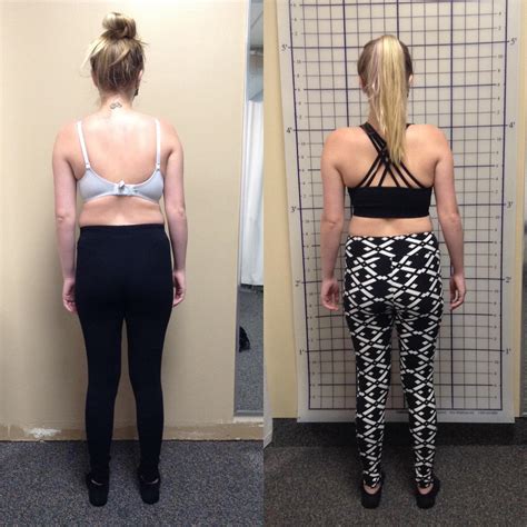 Confused About My Curves Scoliosis