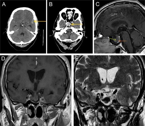 A Subarachnoid Haemorrhage Seen In The Sylvian Download