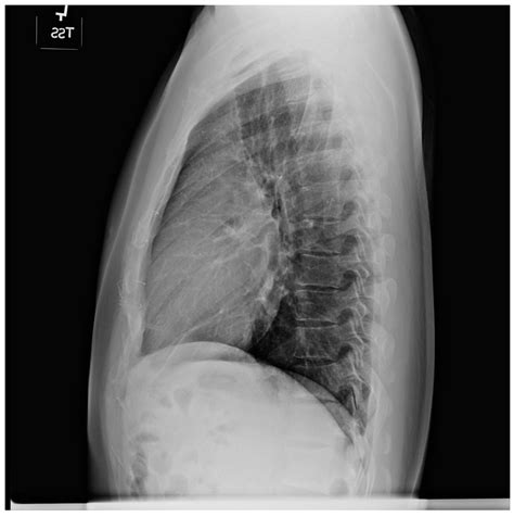 Normal Neonatal Chest X Ray At Gilda Pittman Blog