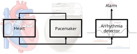 pacemaker with an arrhythmia detector download scientific diagram