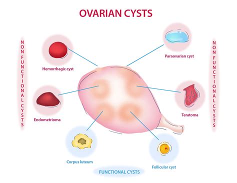 What Is Hemorrhagic Corpus Luteum