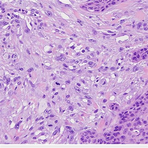 High Power View Illustrating The Pleomorphic Multinucleated Cells With