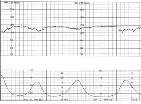 Fetal Monitoring Intermittent Or Continuous Part Two Be Healthy Be Happy