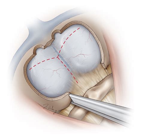Posterior Fossa Craniotomy
