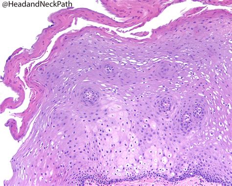 Smokeless Tobacco Keratosis Histology At Debra Covington Blog