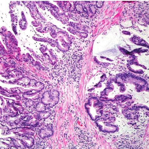 The Egd Reveals This Friable And Fungating Mass 30 Cm From The Incisors