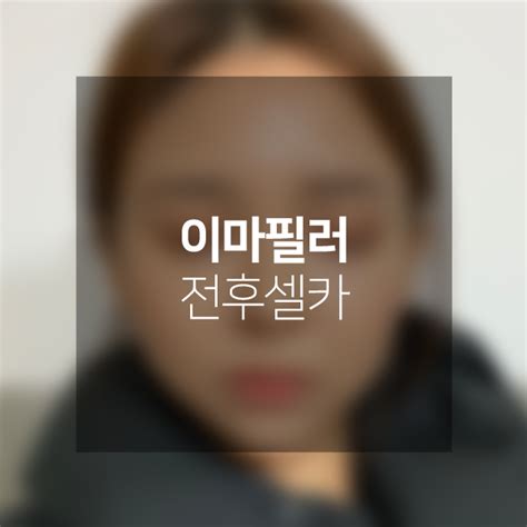 아이엠성형외과 💜이마에 볼륨을 채우는💜 볼륨이마필러 어느 각도에서도 예쁜이마 얼굴의 입체감을 Facebook
