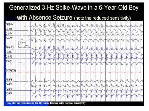 Abnormal Eeg Patterns Ppt